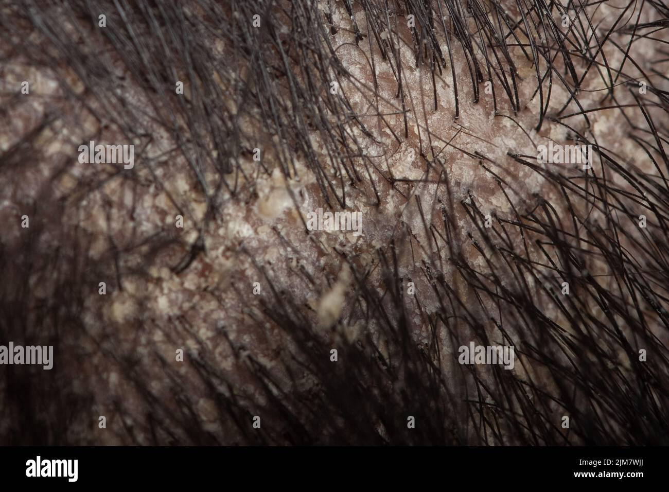 Young Man Have Dandruff Problem Dry Scalp Weak Hair Strand Fungus On