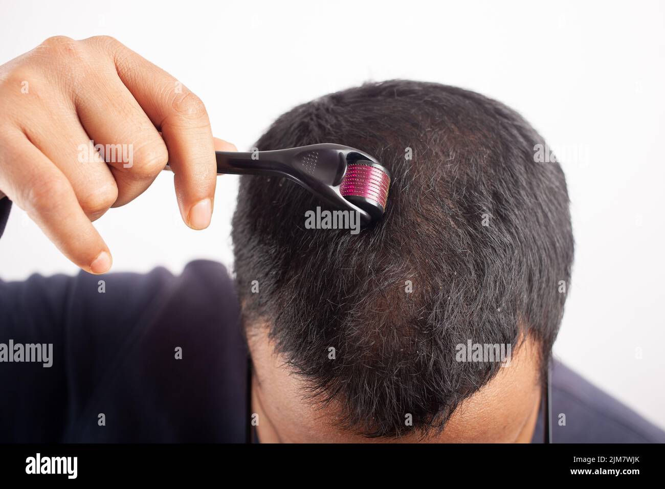 collagen induction therapy, guy using derma roller on head for the ...