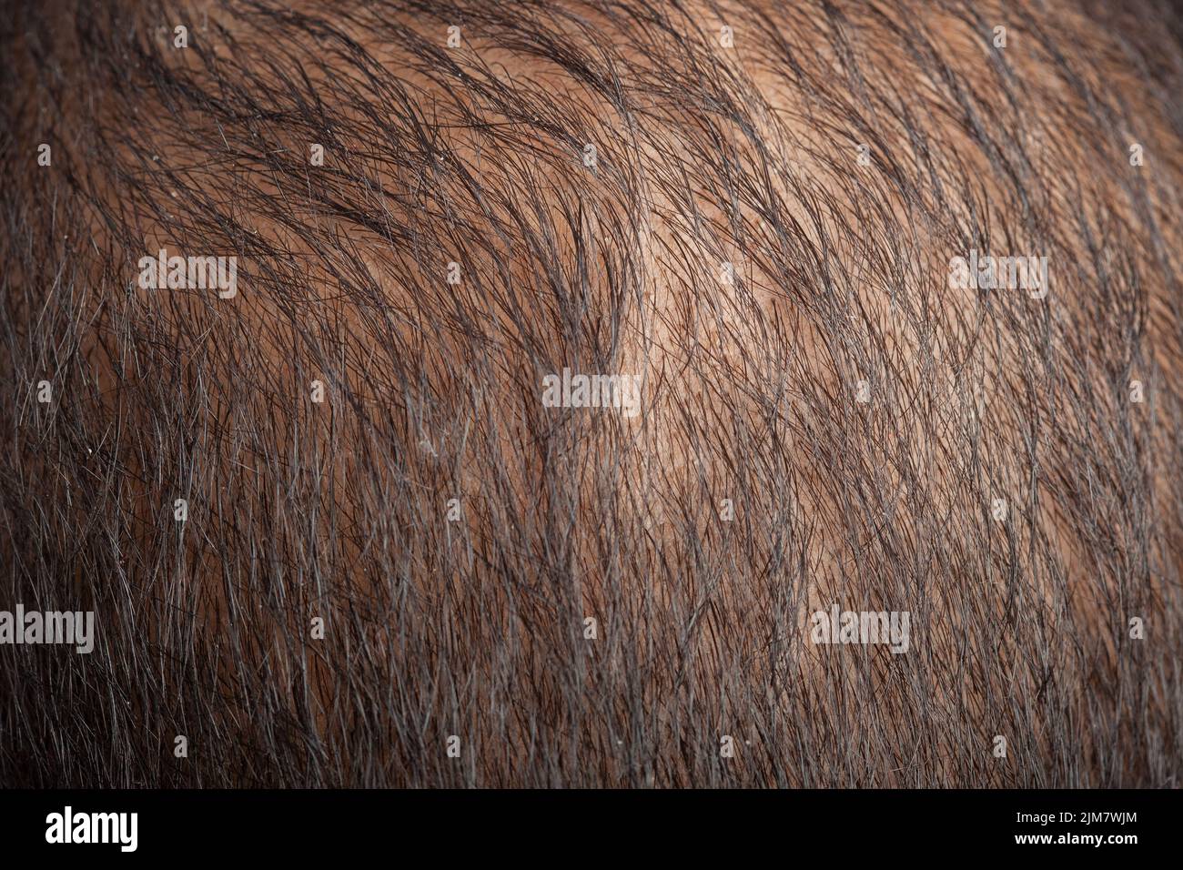 macro view of a man showing top crown area of the head suffering from ...