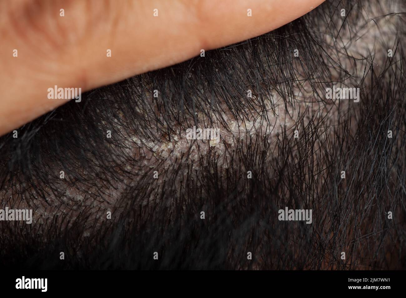 man showing dandruff problem and flaking on scalp due to seborrheic ...