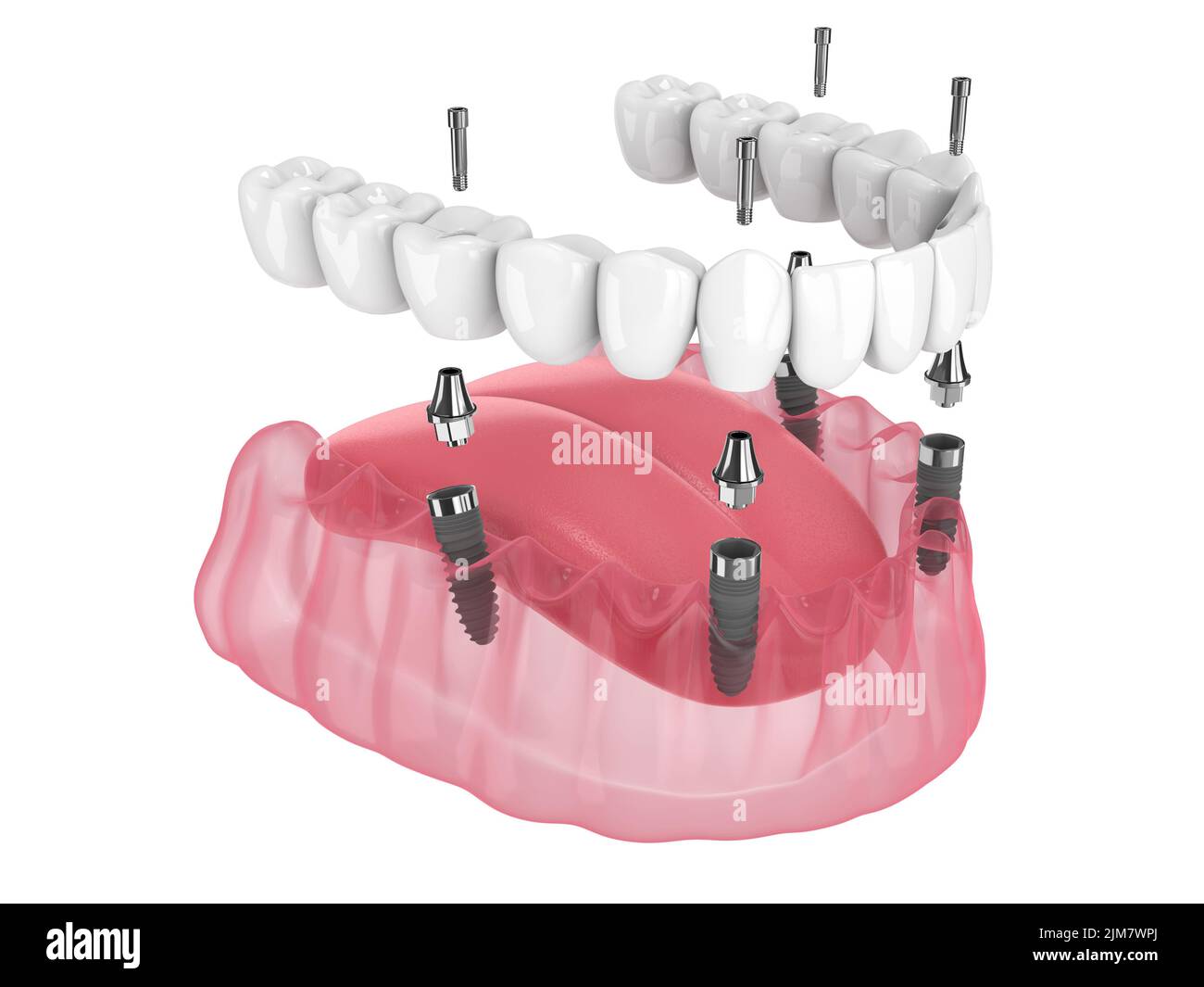 Mandibular prosthesis all on 4 system supported by implants over white ...