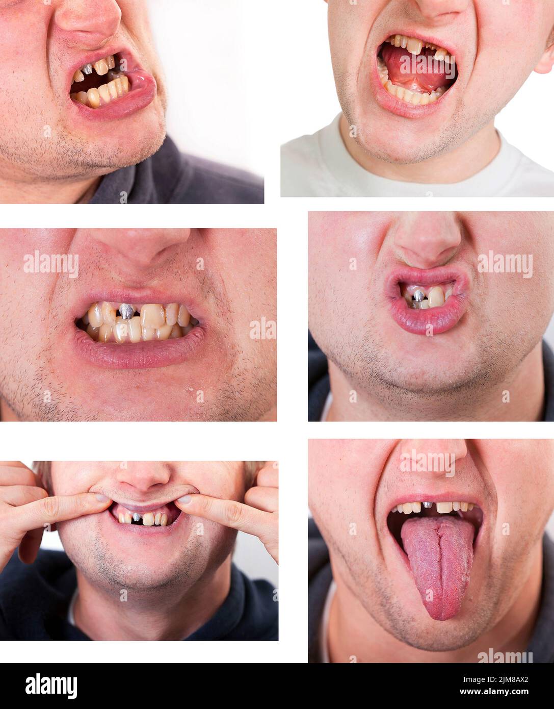 Young man face with broken tooth Stock Photo - Alamy