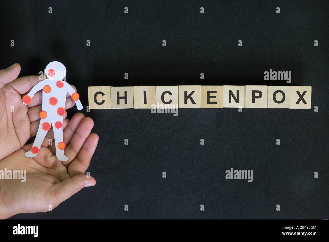 Chickenpox disease infection outbreak care, prevention and protection ...