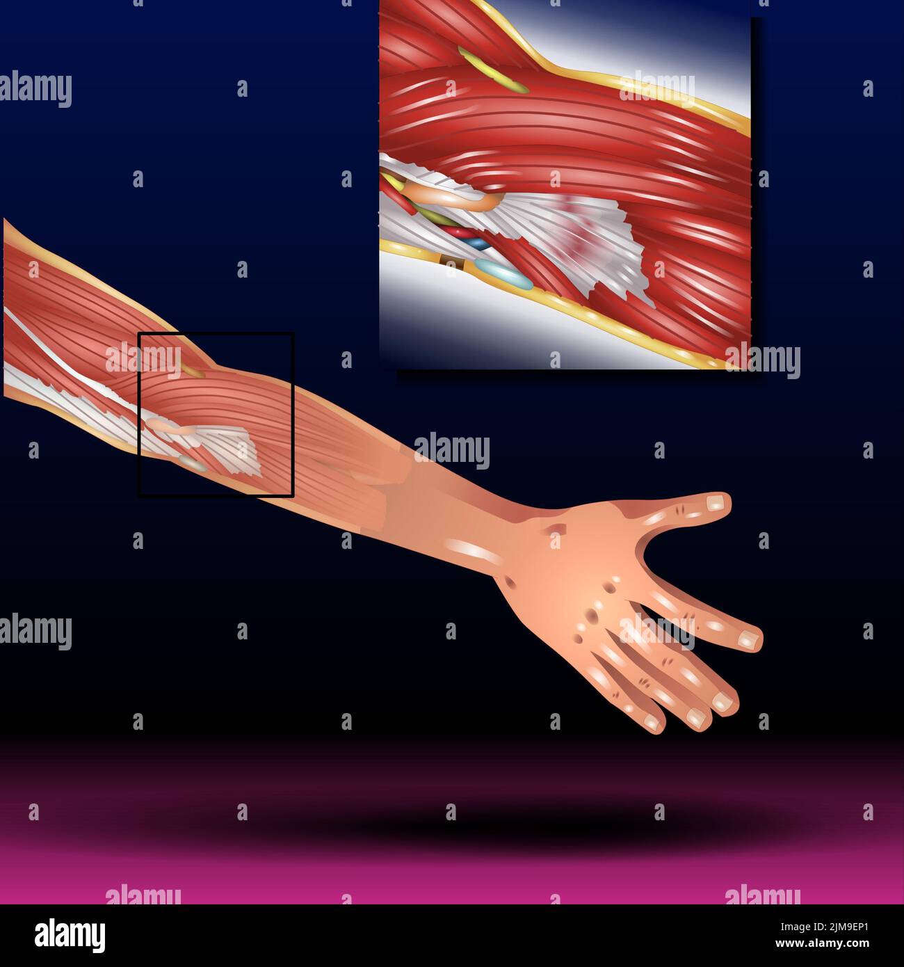 Triceps tendon hi-res stock photography and images - Alamy
