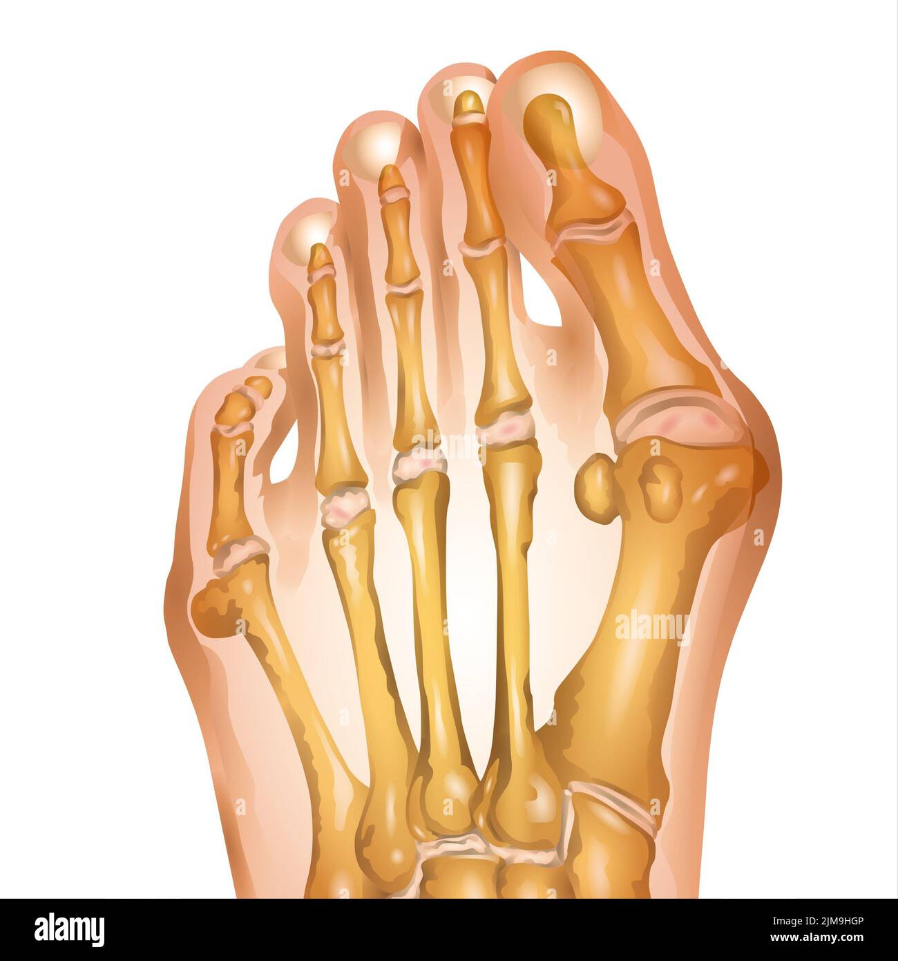 Broken bones on finger hi-res stock photography and images - Alamy