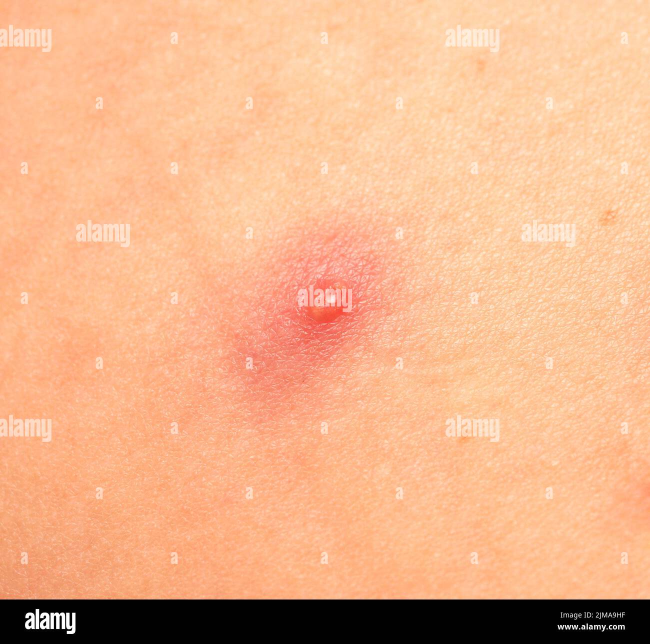 Red pimple hi-res stock photography and images - Alamy