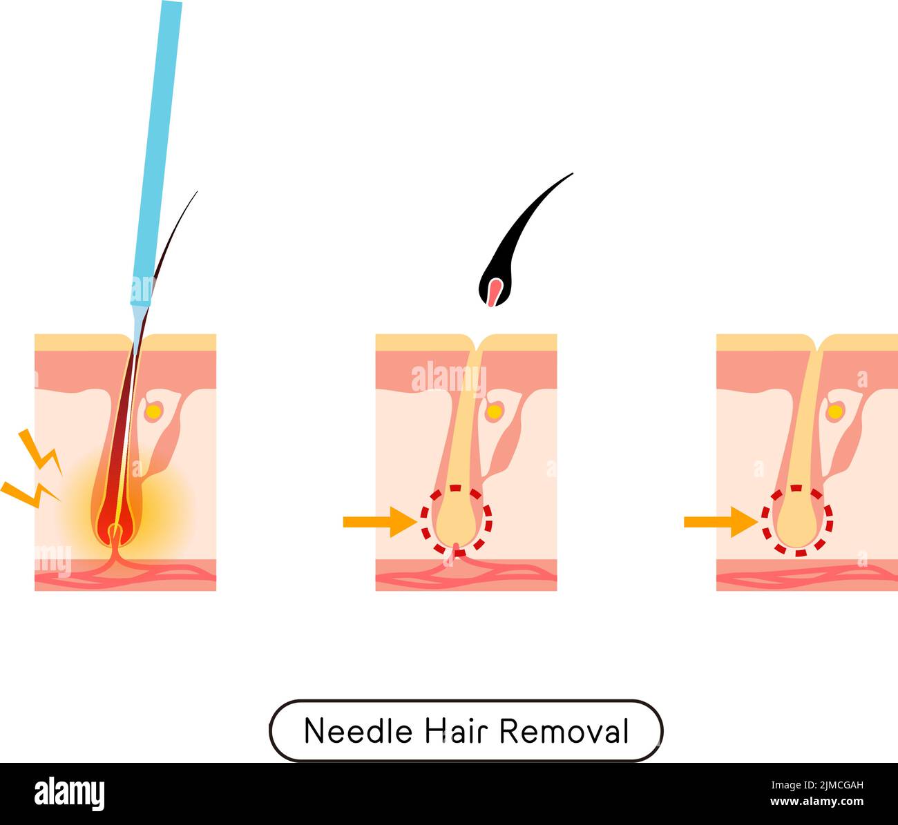 Image of hair removal, the process of hair removal after needle hair ...