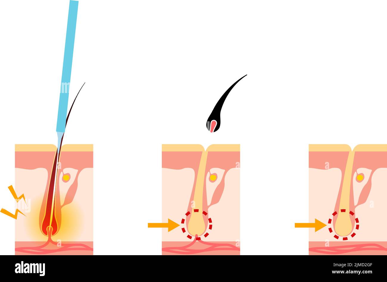 Image of hair removal, the process of hair removal after needle hair ...