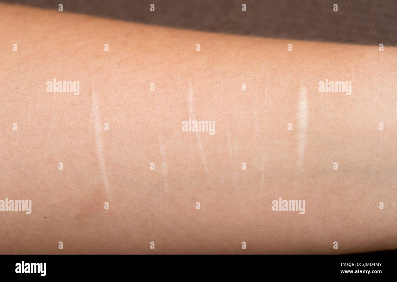 Scar hand hi-res stock photography and images - Alamy