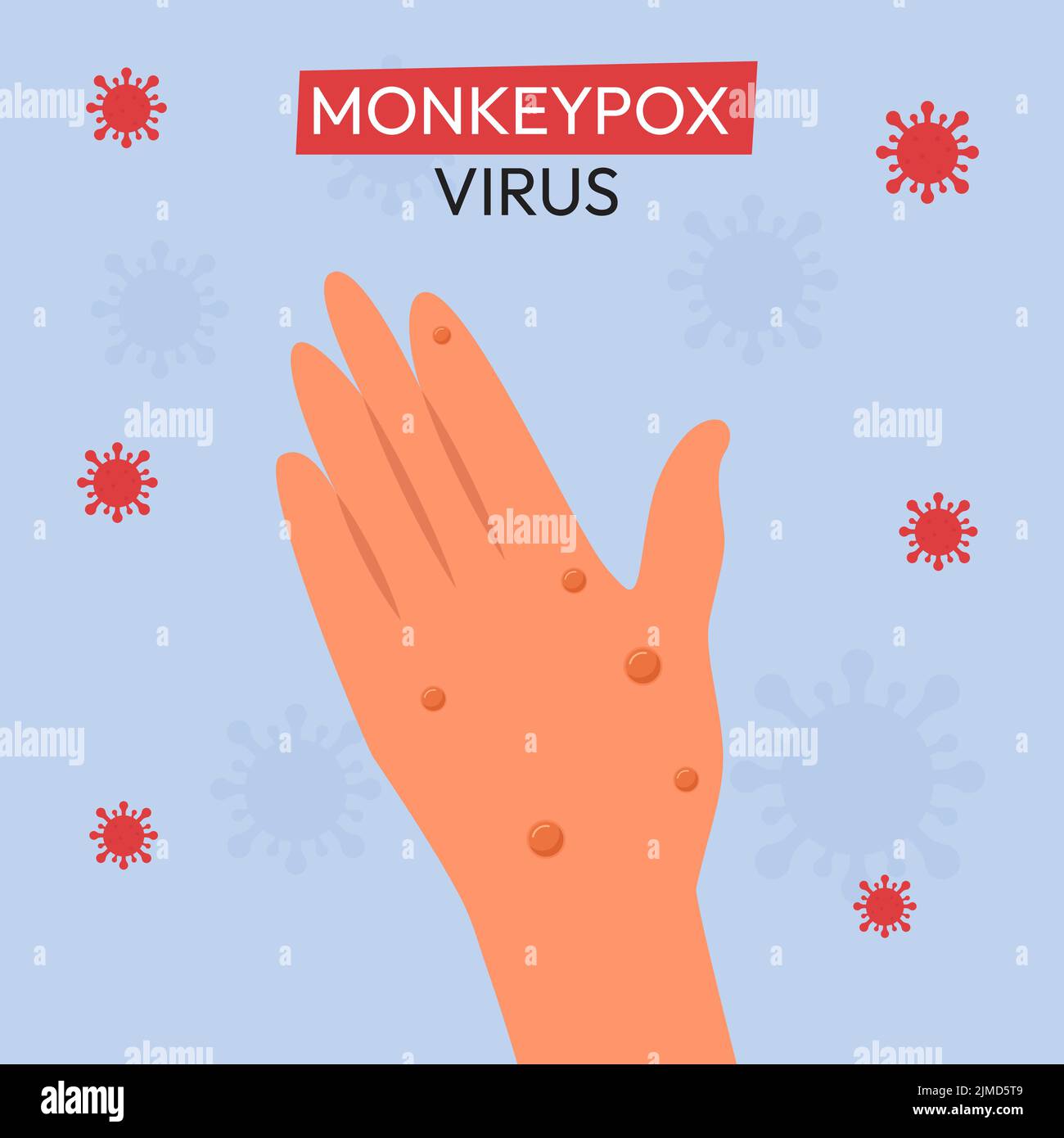 Monkeypox outbreak. Monkeypox are shown on the patient's hand. Flat ...