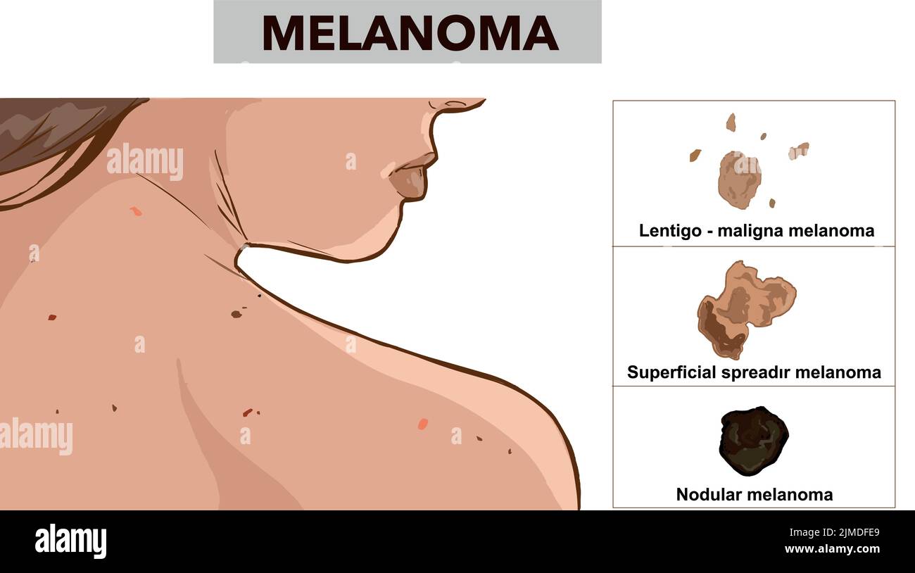 Three types of melanoma vector image Stock Vector Image & Art - Alamy