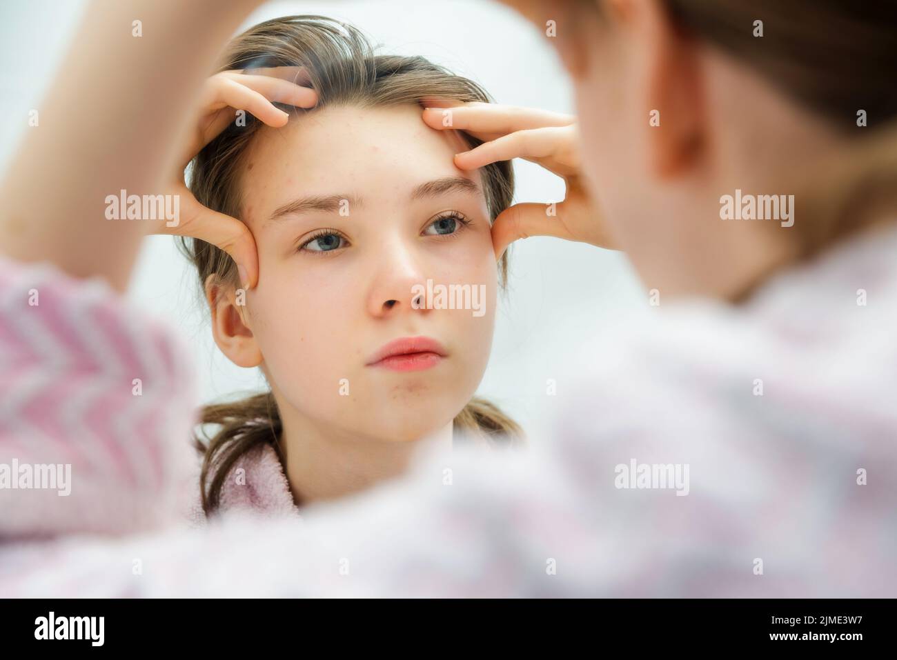 Sad teenage girl with acne on her face Stock Photo - Alamy