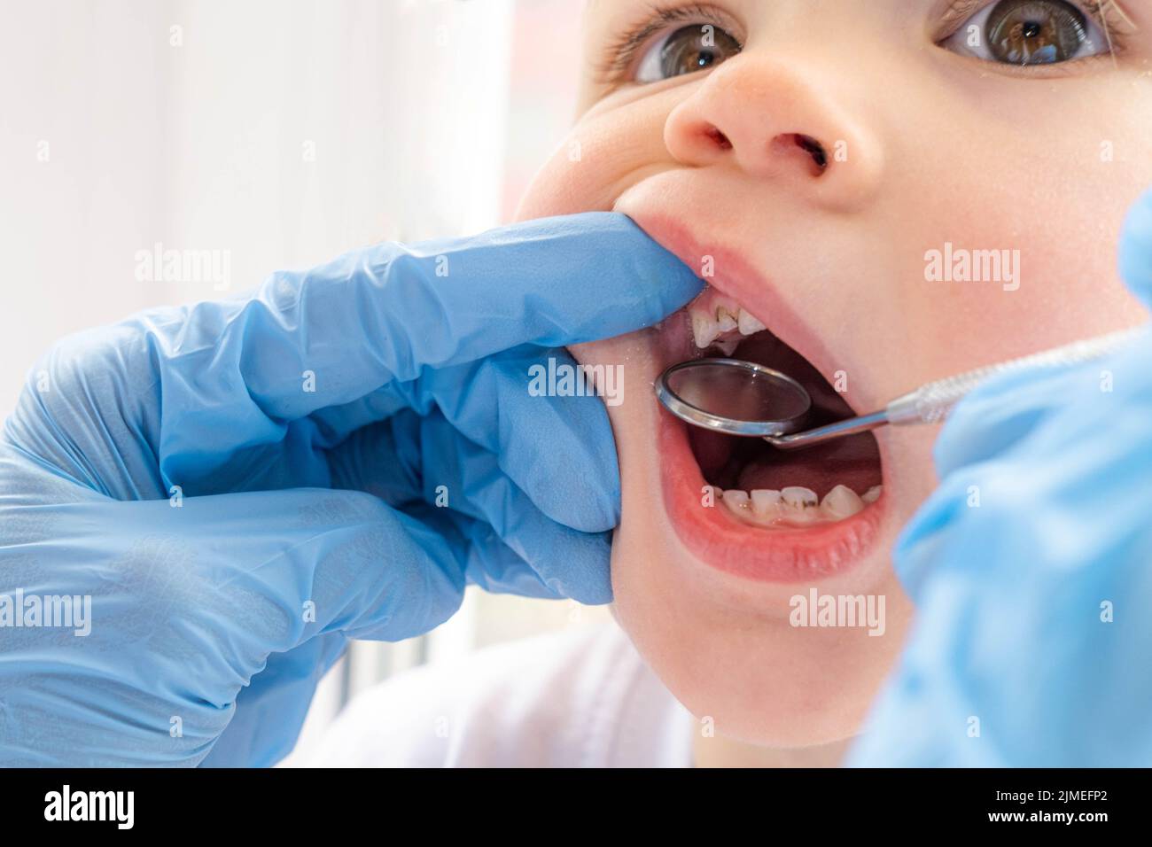 Closeup open mouth child and mirror in dentists hands in blue gloves ...