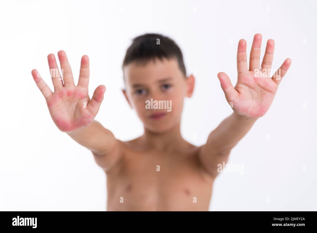 child shows his hands with dermatitis and eczema Stock Photo - Alamy