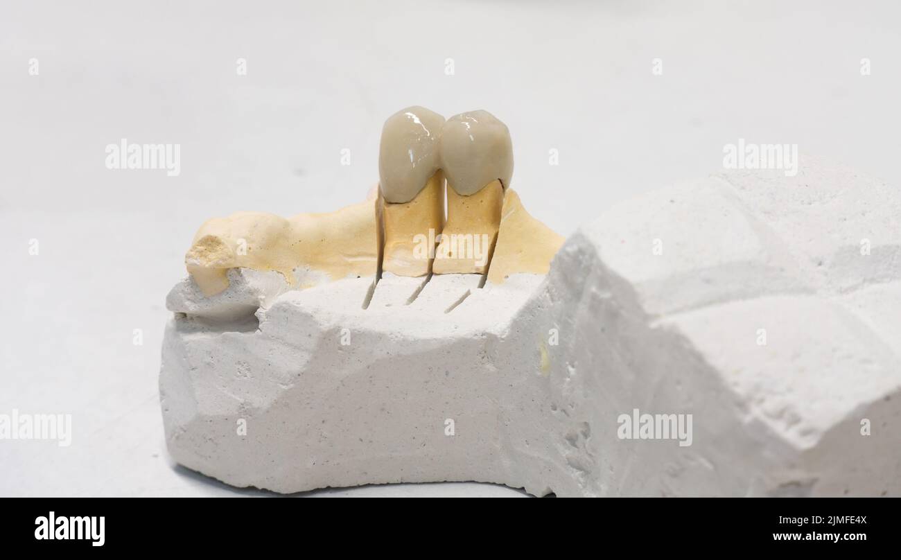 Artificial teeth are made of ceramics for the patient Stock Photo - Alamy