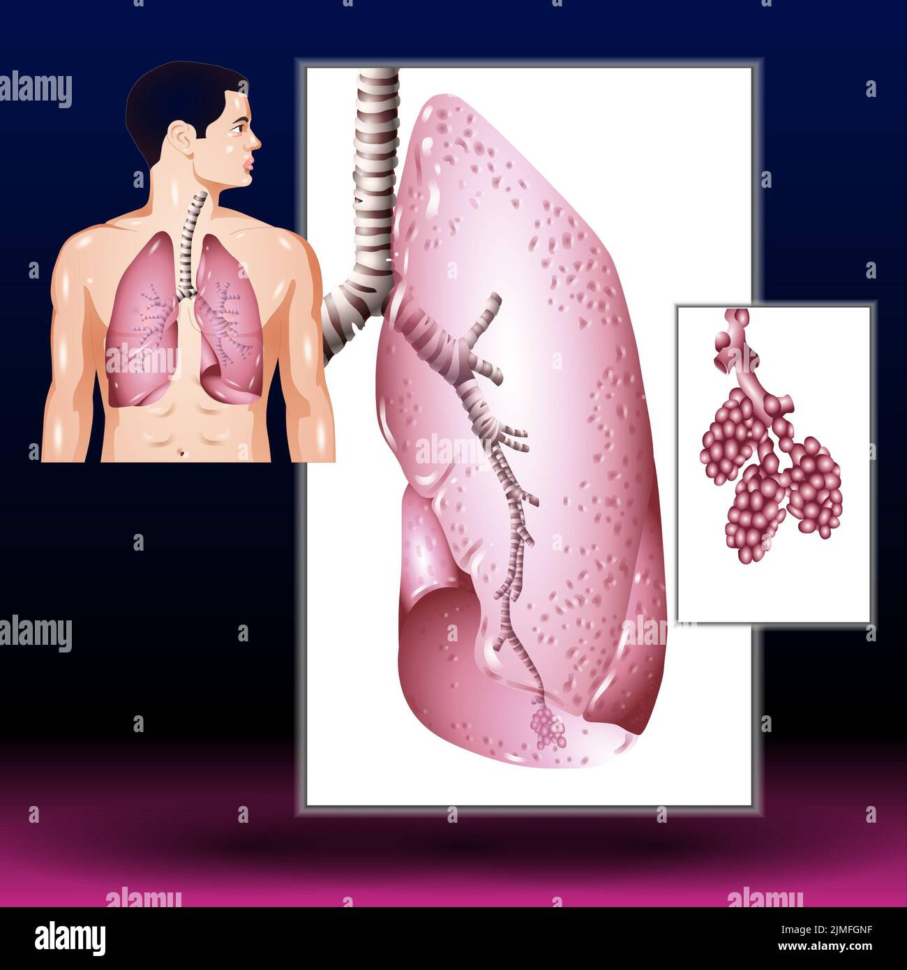 Pneumonia lung drawing hi-res stock photography and images - Alamy