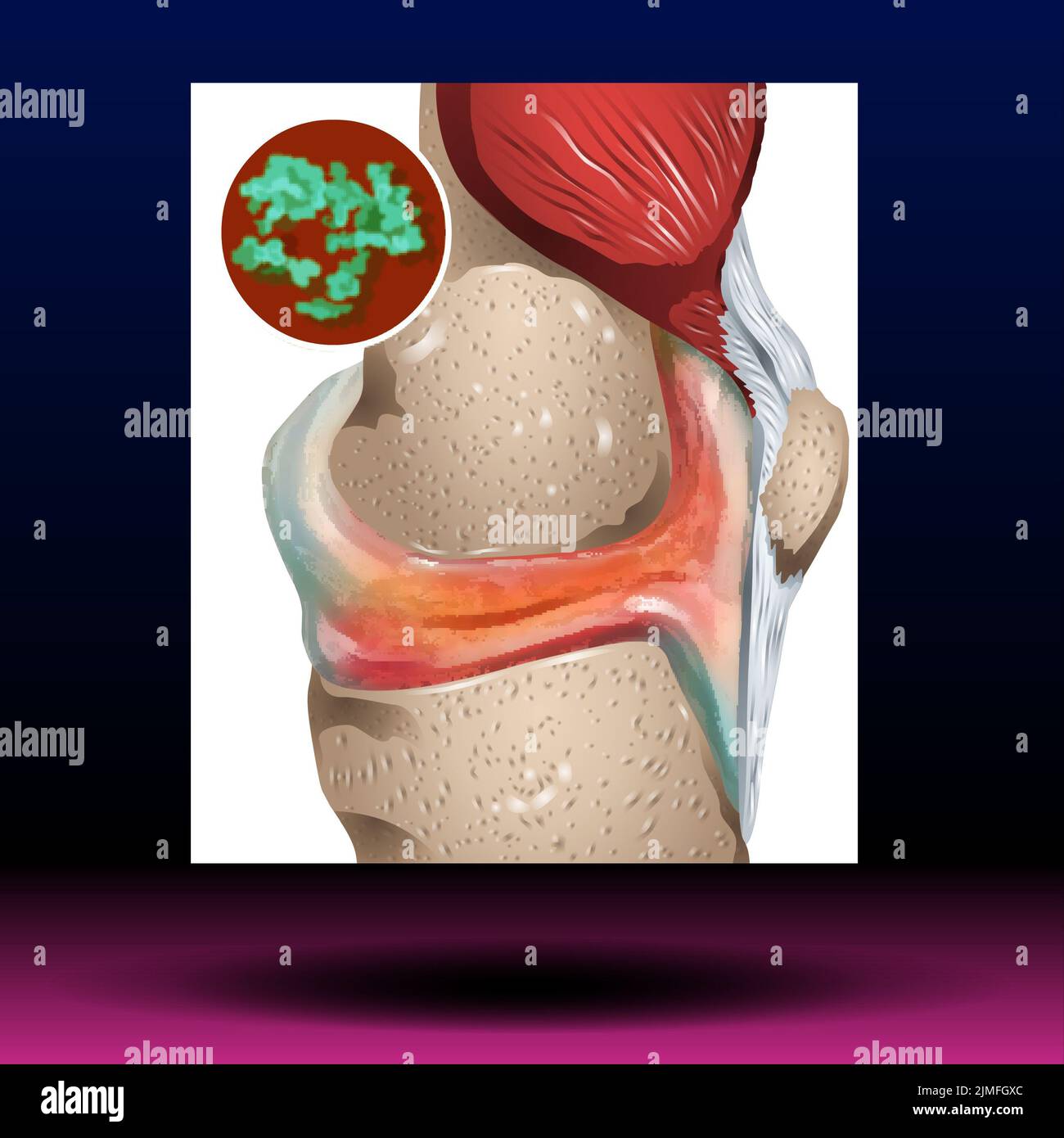 Joint anatomy osteoarthritis rheumatoid arthritis hi-res stock ...
