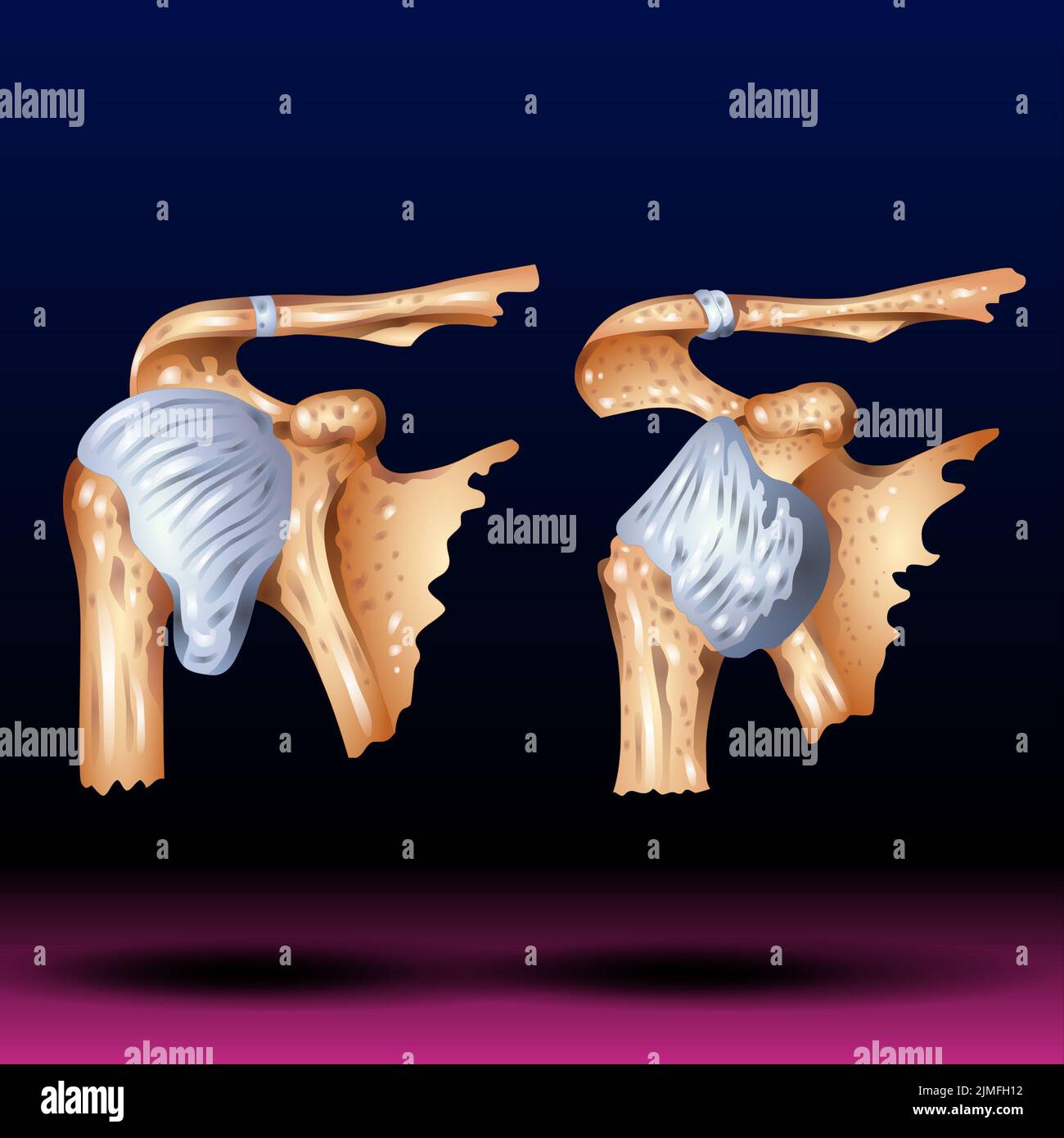 Dislocation shoulder hi-res stock photography and images - Alamy
