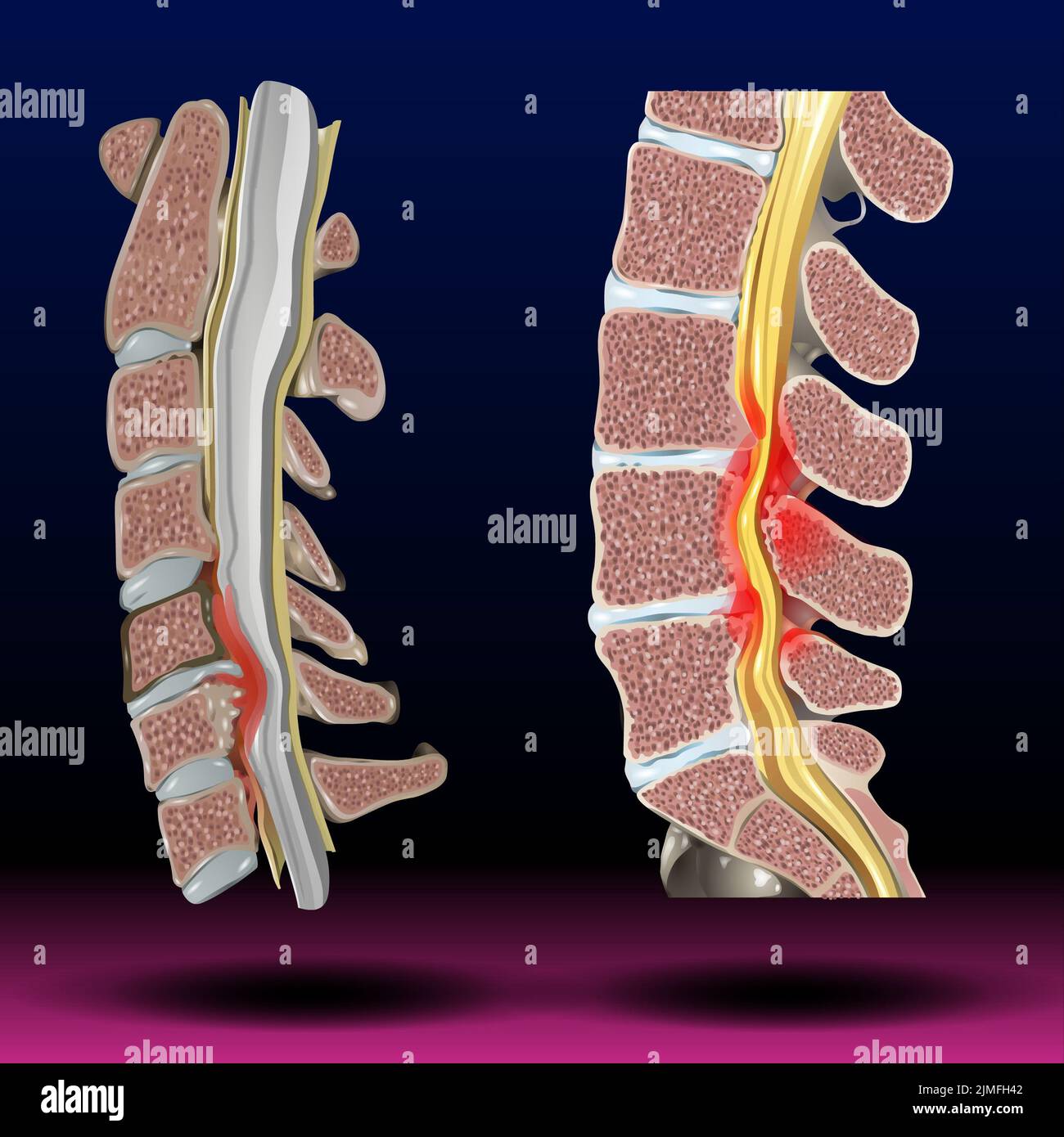 Spinal stenosis hi-res stock photography and images - Alamy