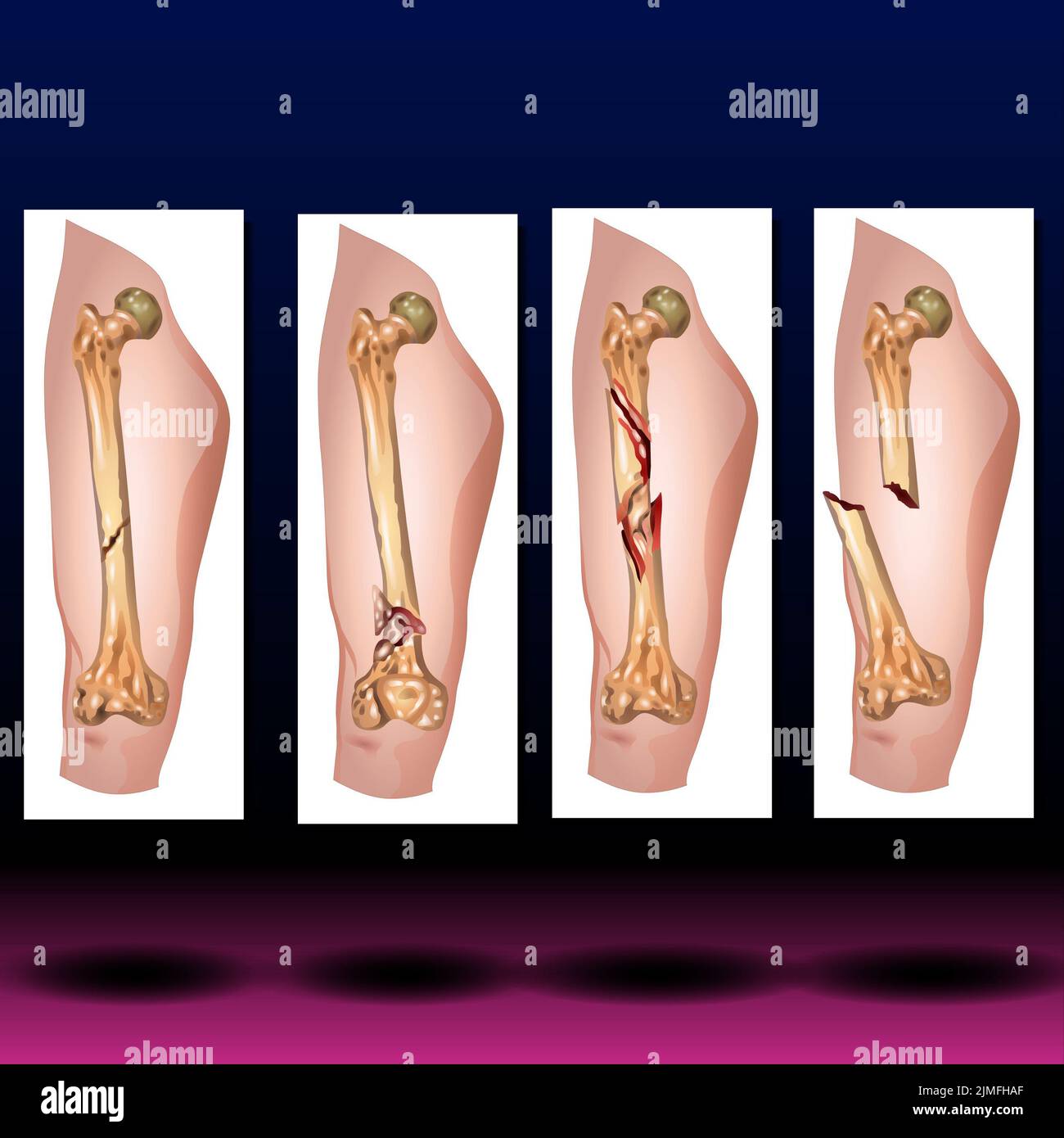 Blood vessels of pelvis hi-res stock photography and images - Alamy
