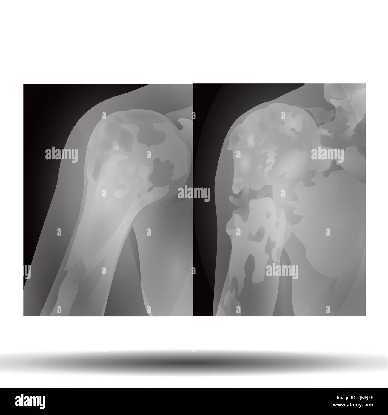 Shoulder pain xray hi-res stock photography and images - Alamy