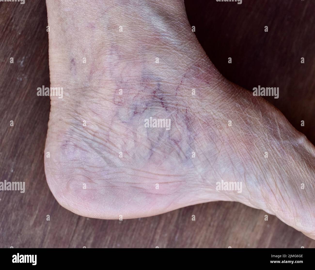 Foot Skin Wrinkles at Johanna Reed blog