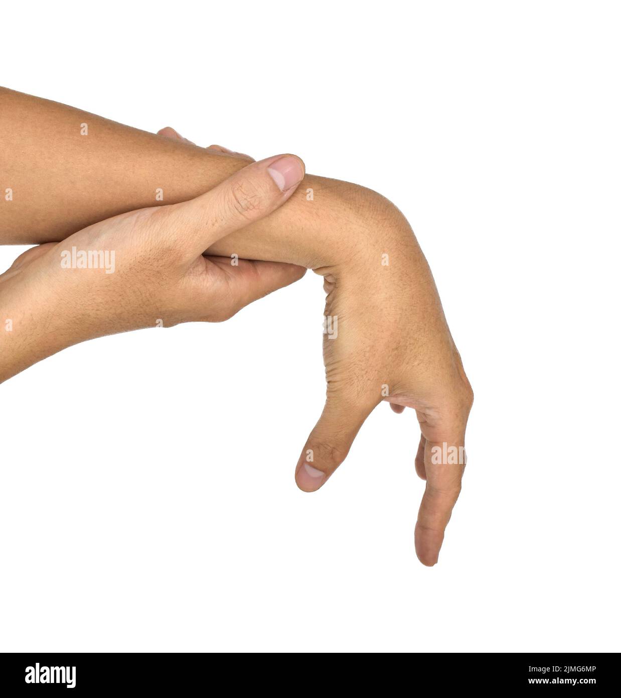 Radial nerve injury or wrist drop of Asian Myanmar man Stock Photo - Alamy