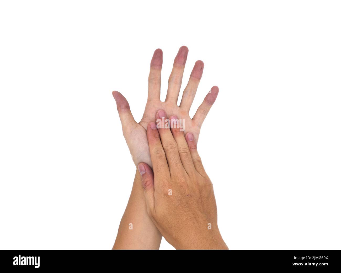 Cyanotic hands or peripheral cyanosis or blue hands at Southeast Asian ...