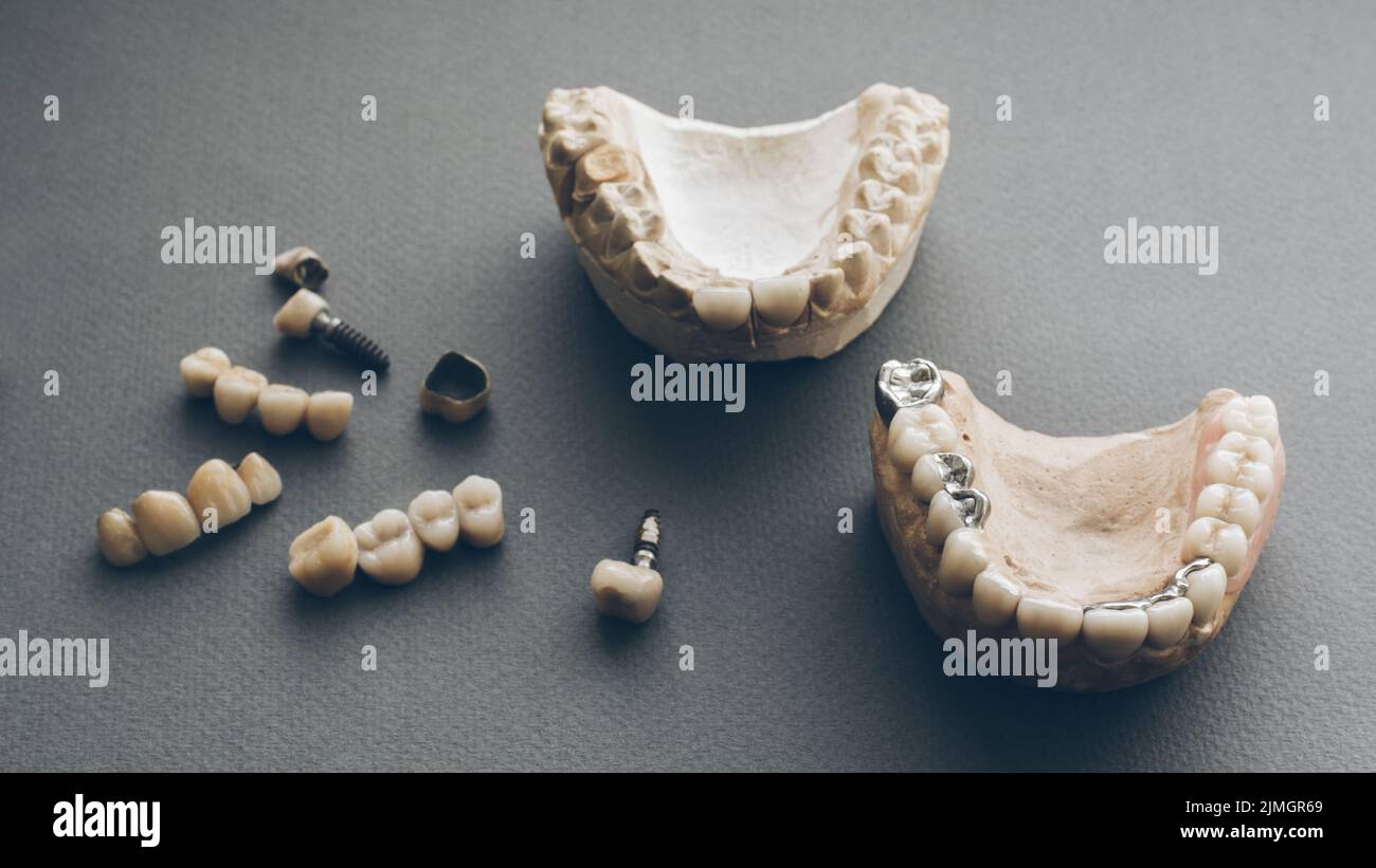 dental prosthesis gypsum jaws dentures crowns Stock Photo - Alamy