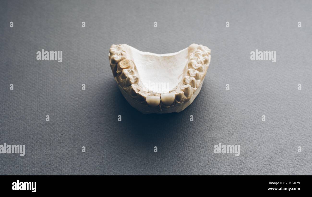 jaw layout ceramic metal denture dental prosthesis Stock Photo - Alamy