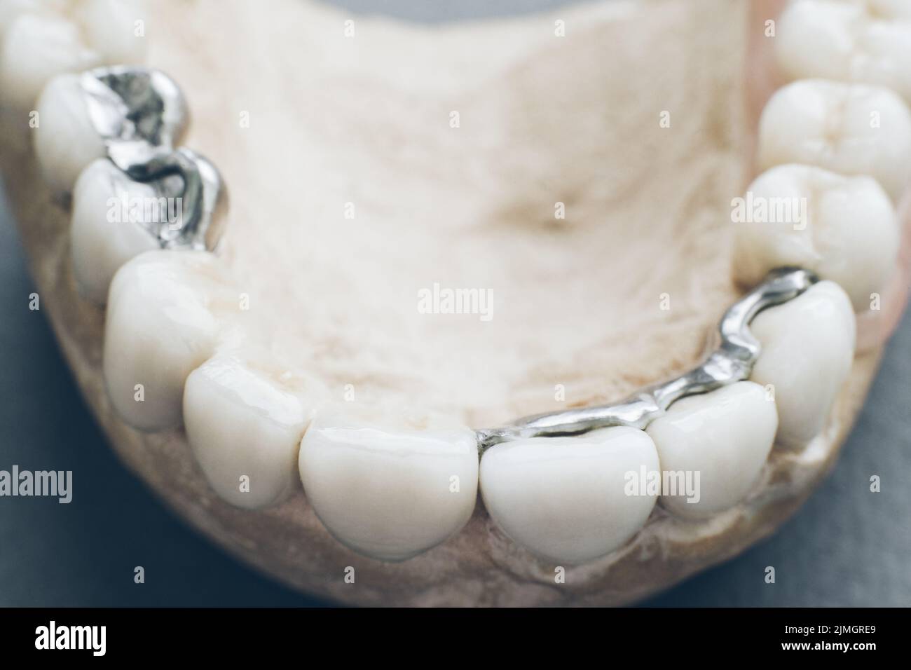 dental implantation jaw ceramic metal denture Stock Photo - Alamy