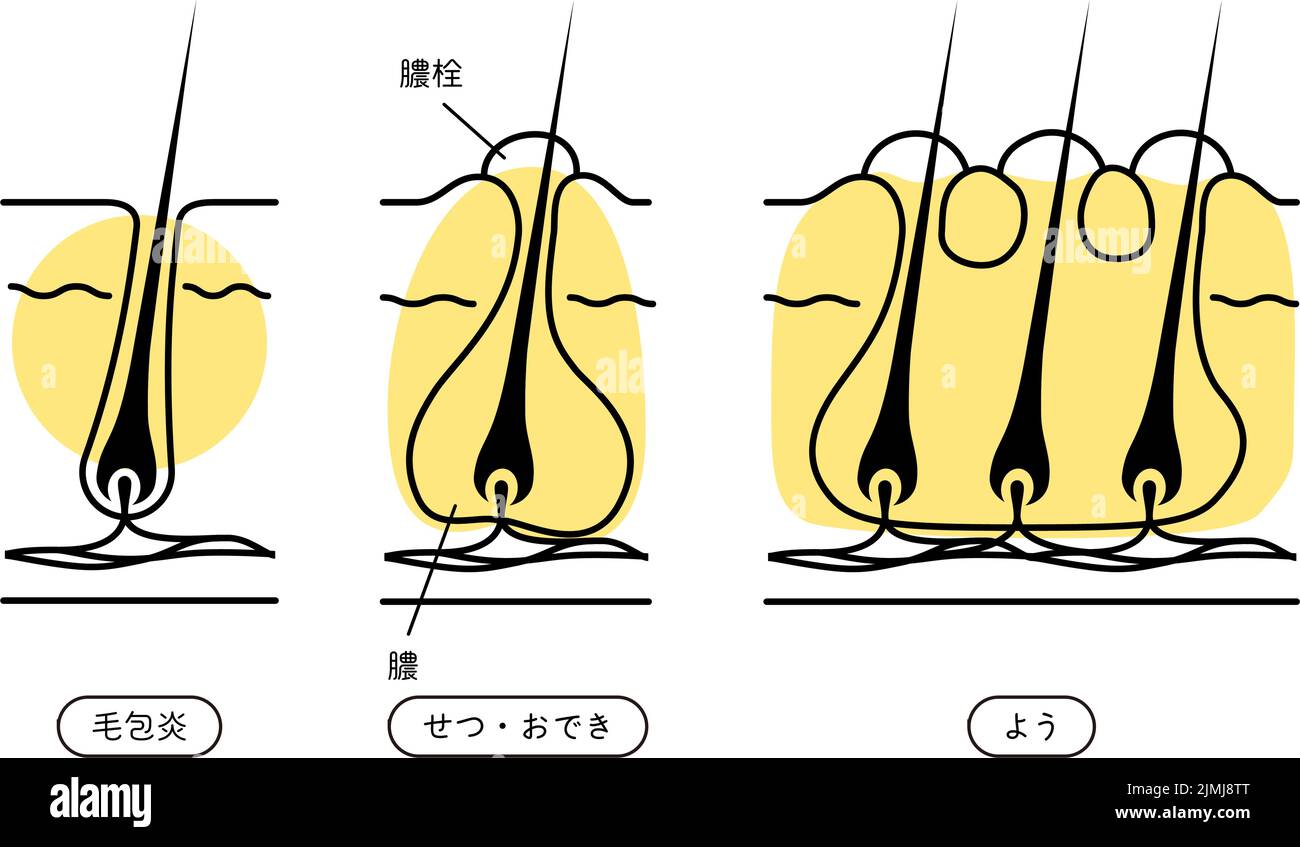 Image of skin problems, rough skin, acne, early to advanced ...