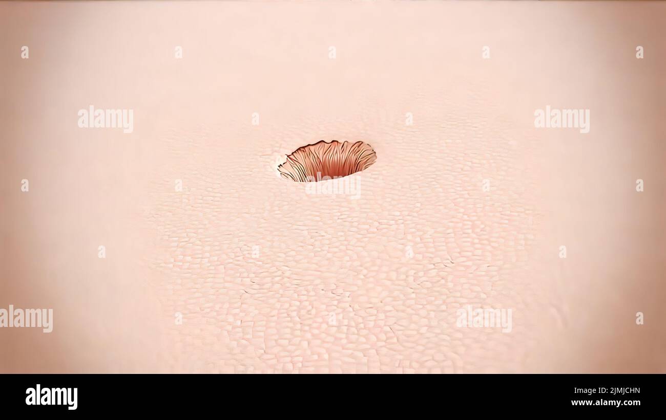 Pustule stages hi-res stock photography and images - Alamy