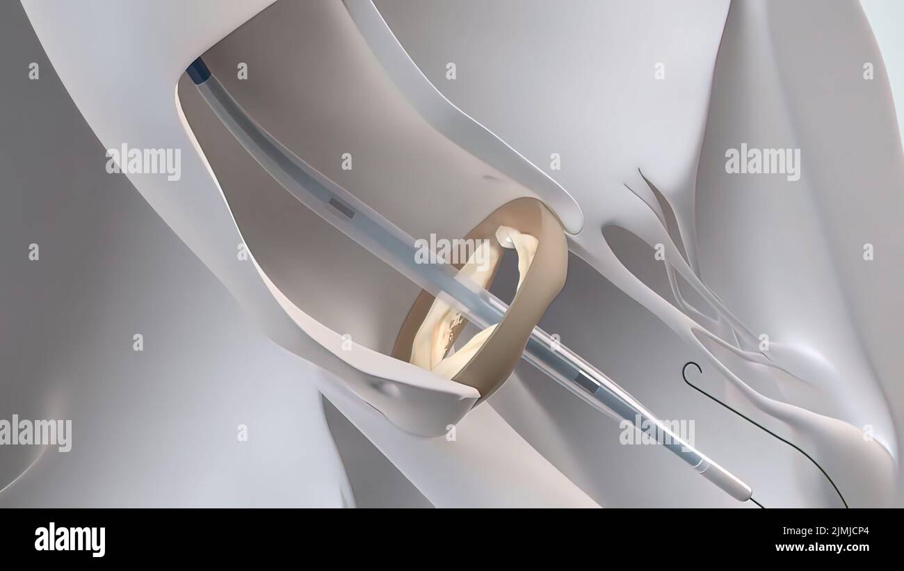 Coronary arteriography hi-res stock photography and images - Alamy