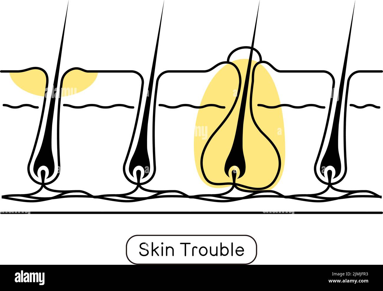 Image of hair removal, skin problems, rough skin from shaving hair ...