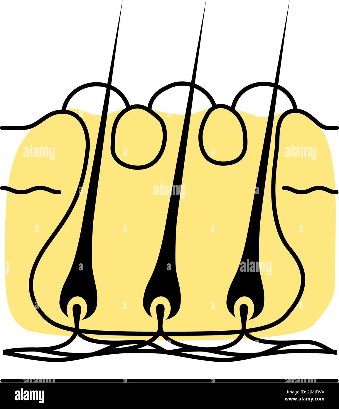 Illustration of a "carbuncle," a subcutaneous connection of multiple ...