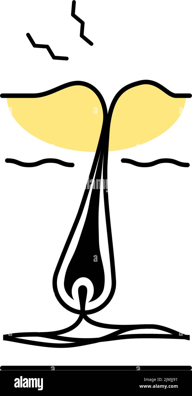 Illustration of acne and skin irritation, image of clogged and inflamed ...
