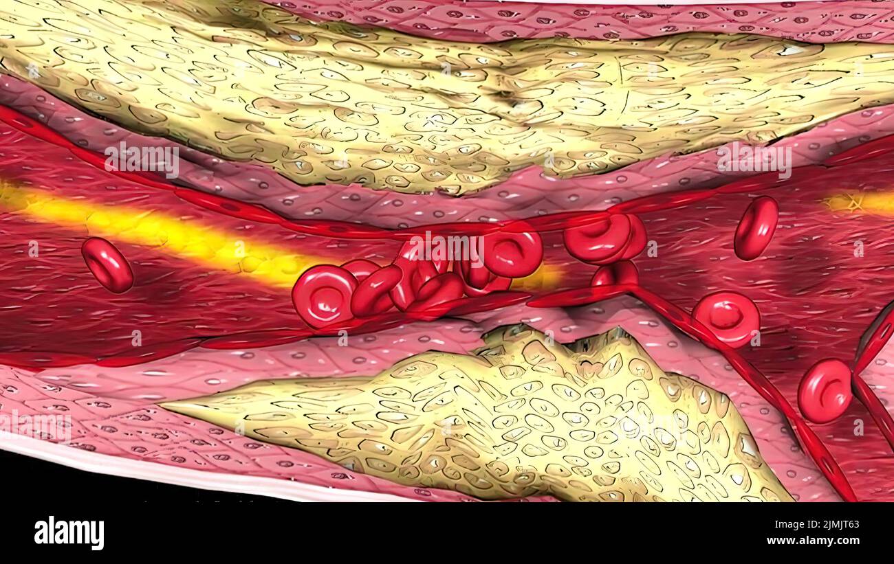 Atherosclerosis micrograph hi-res stock photography and images - Alamy