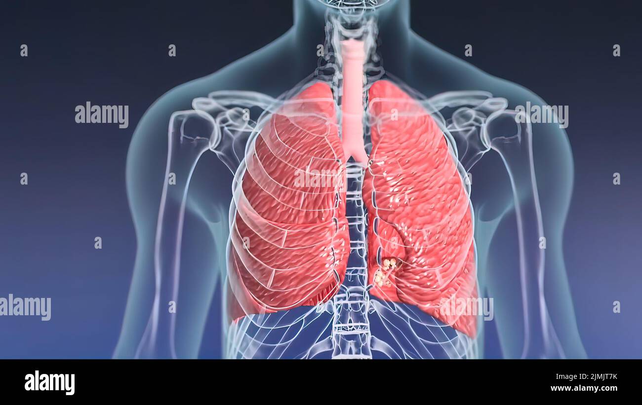 Bronchiole constriction hi-res stock photography and images - Alamy