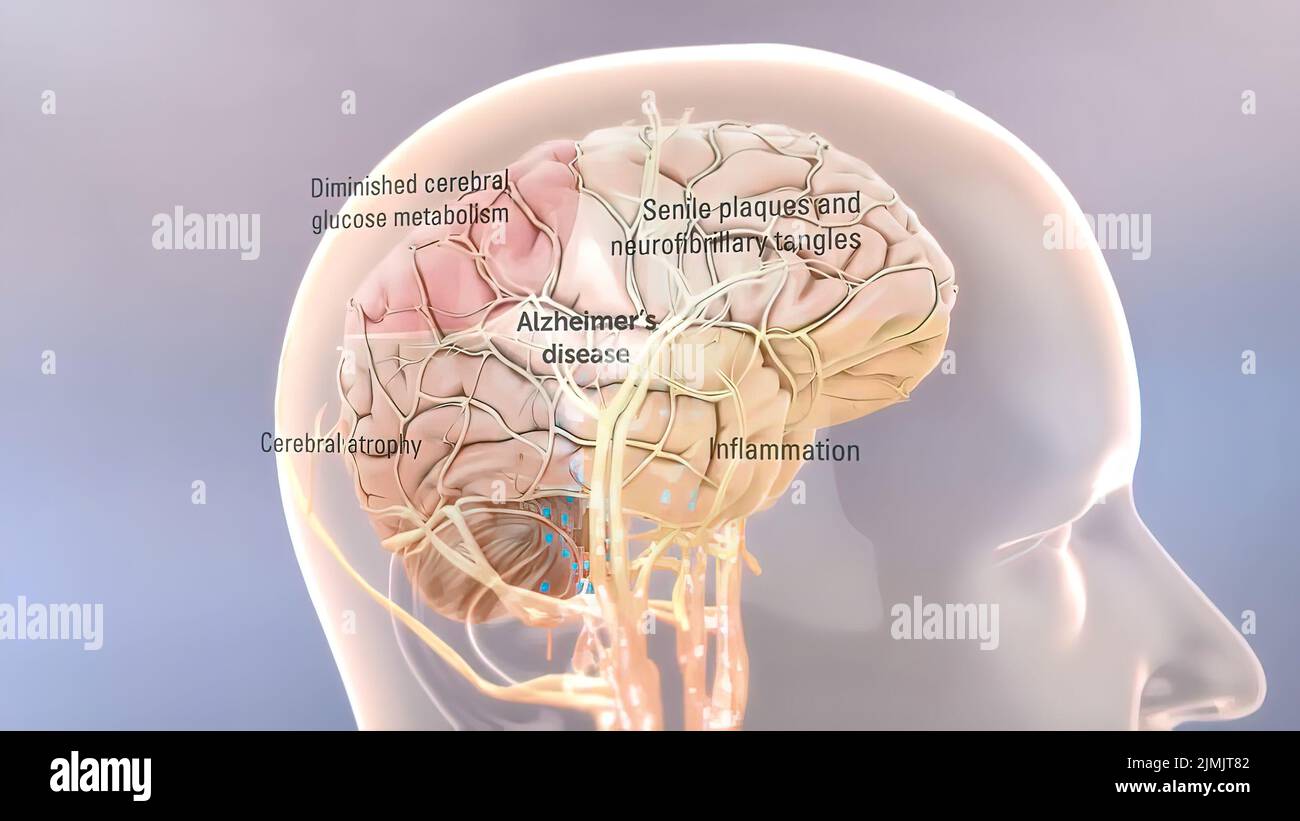 Alzheimer's disease plaques hi-res stock photography and images - Alamy