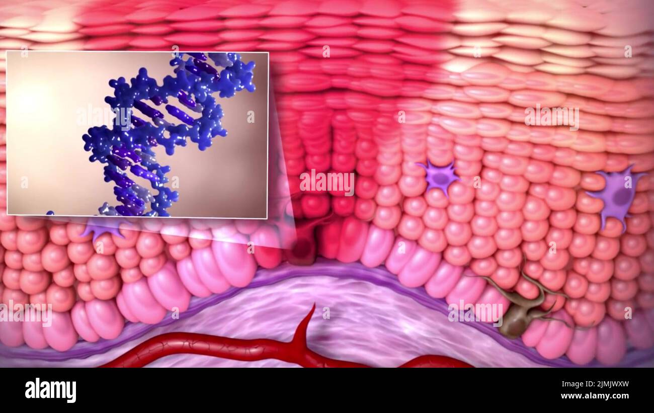 Cancer of the stomach histology hi-res stock photography and images - Alamy