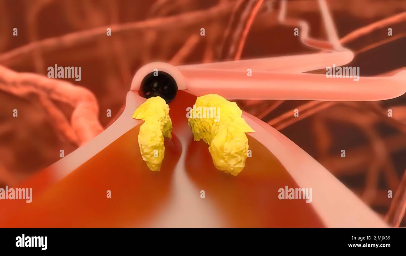 Artery plaque lining hi-res stock photography and images - Alamy