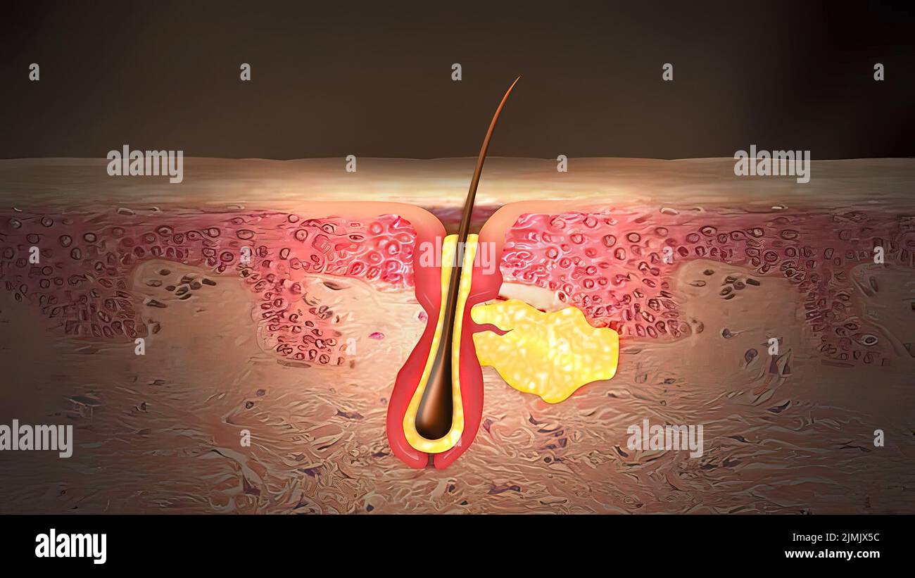 Pustule stages hi-res stock photography and images - Alamy
