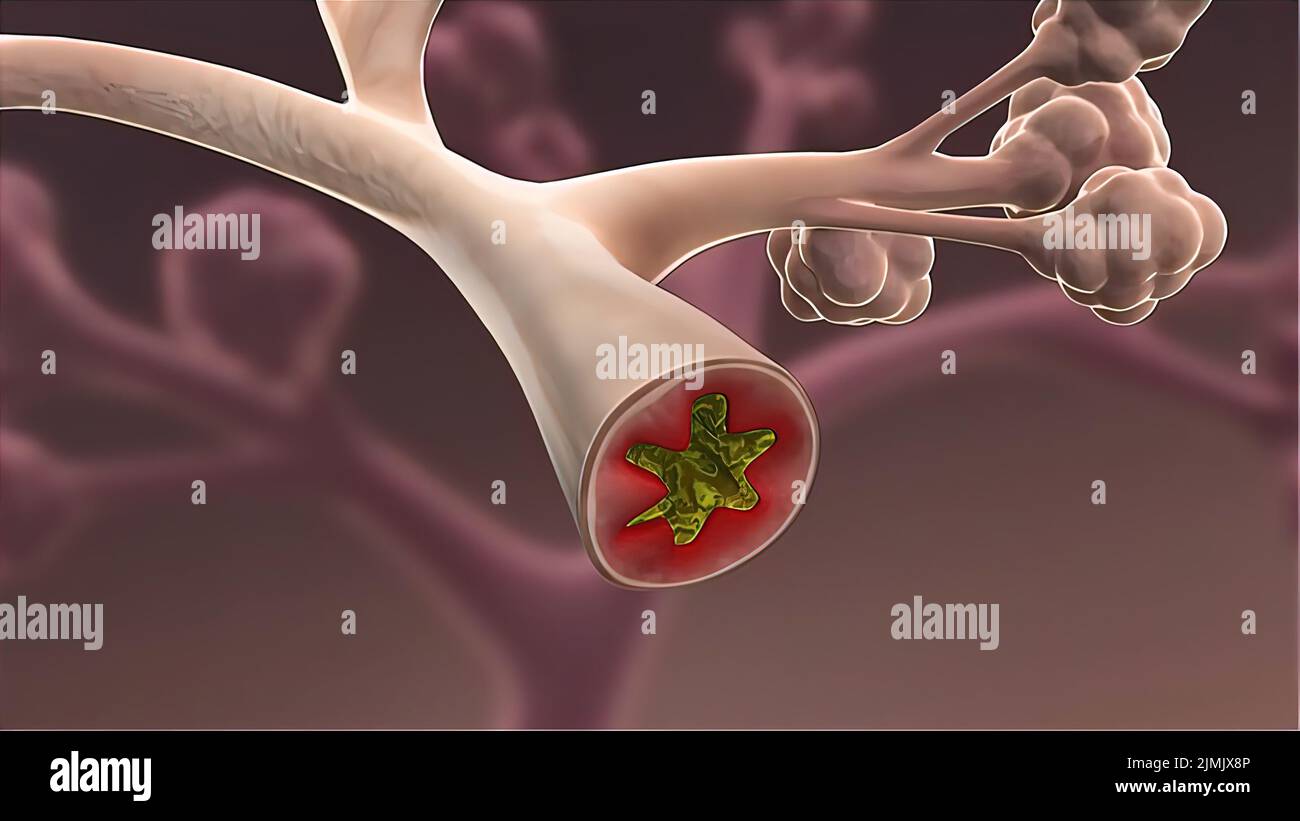 Bronchiole constriction hi-res stock photography and images - Alamy
