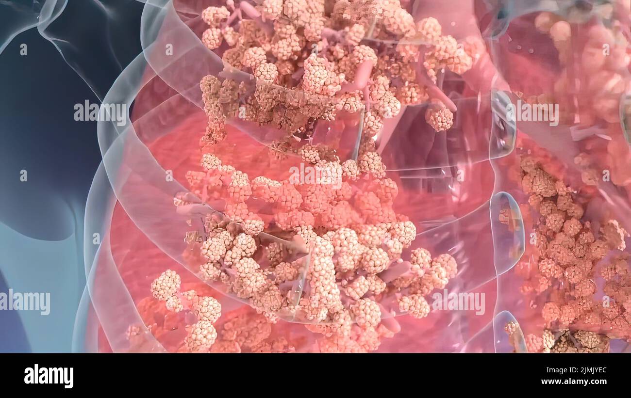 Bronchus with excess mucus hi-res stock photography and images - Alamy