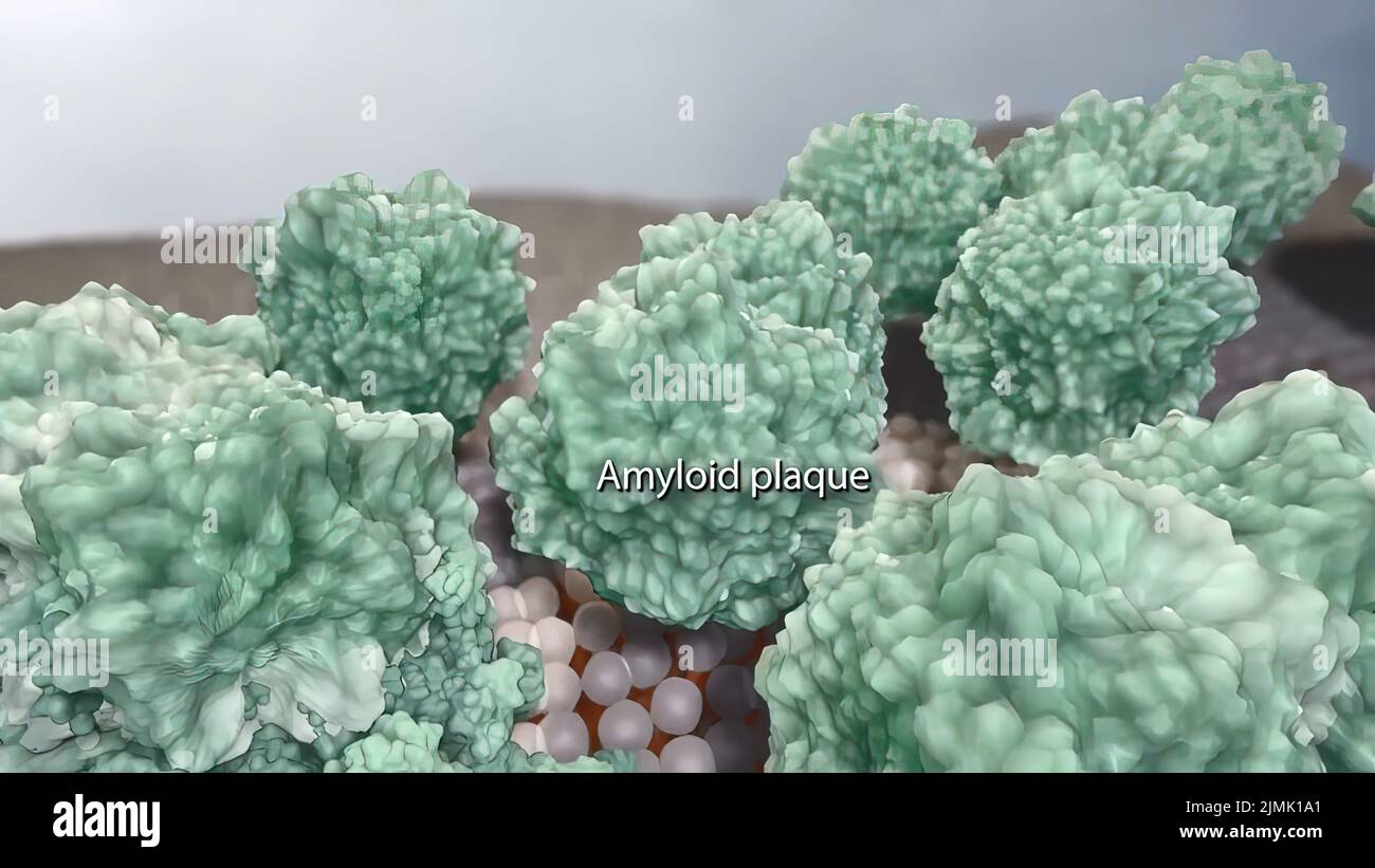 Alzheimer's disease plaques hi-res stock photography and images - Alamy
