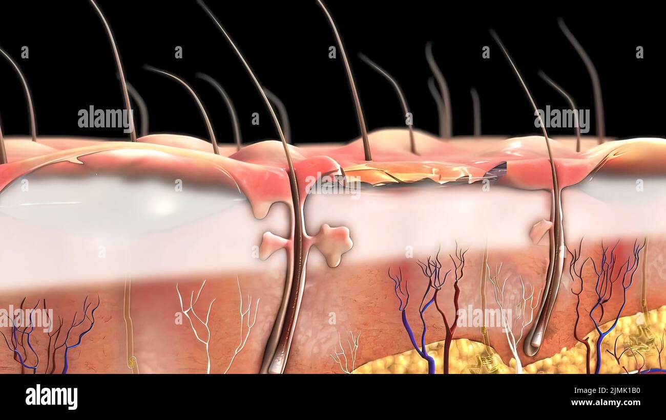 Body burns hi-res stock photography and images - Alamy