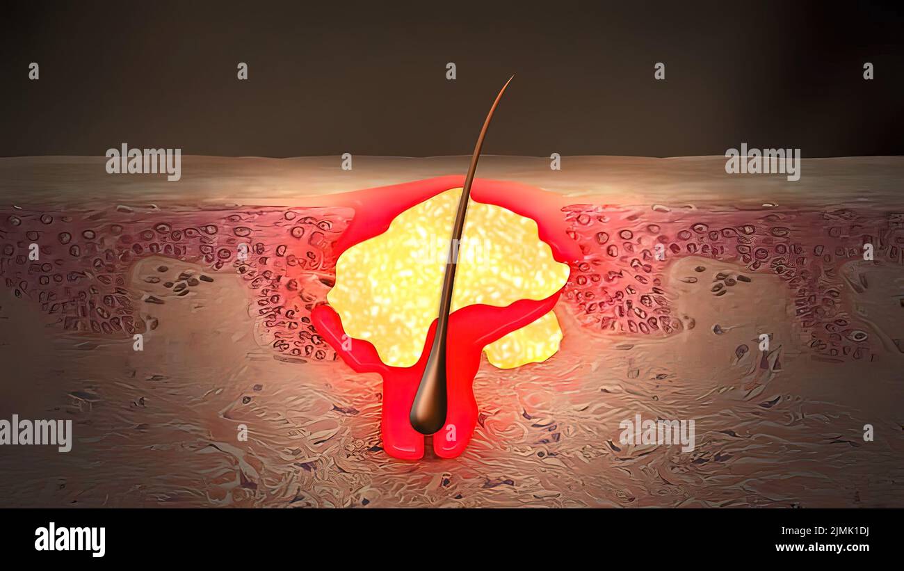 Infect hi-res stock photography and images - Alamy