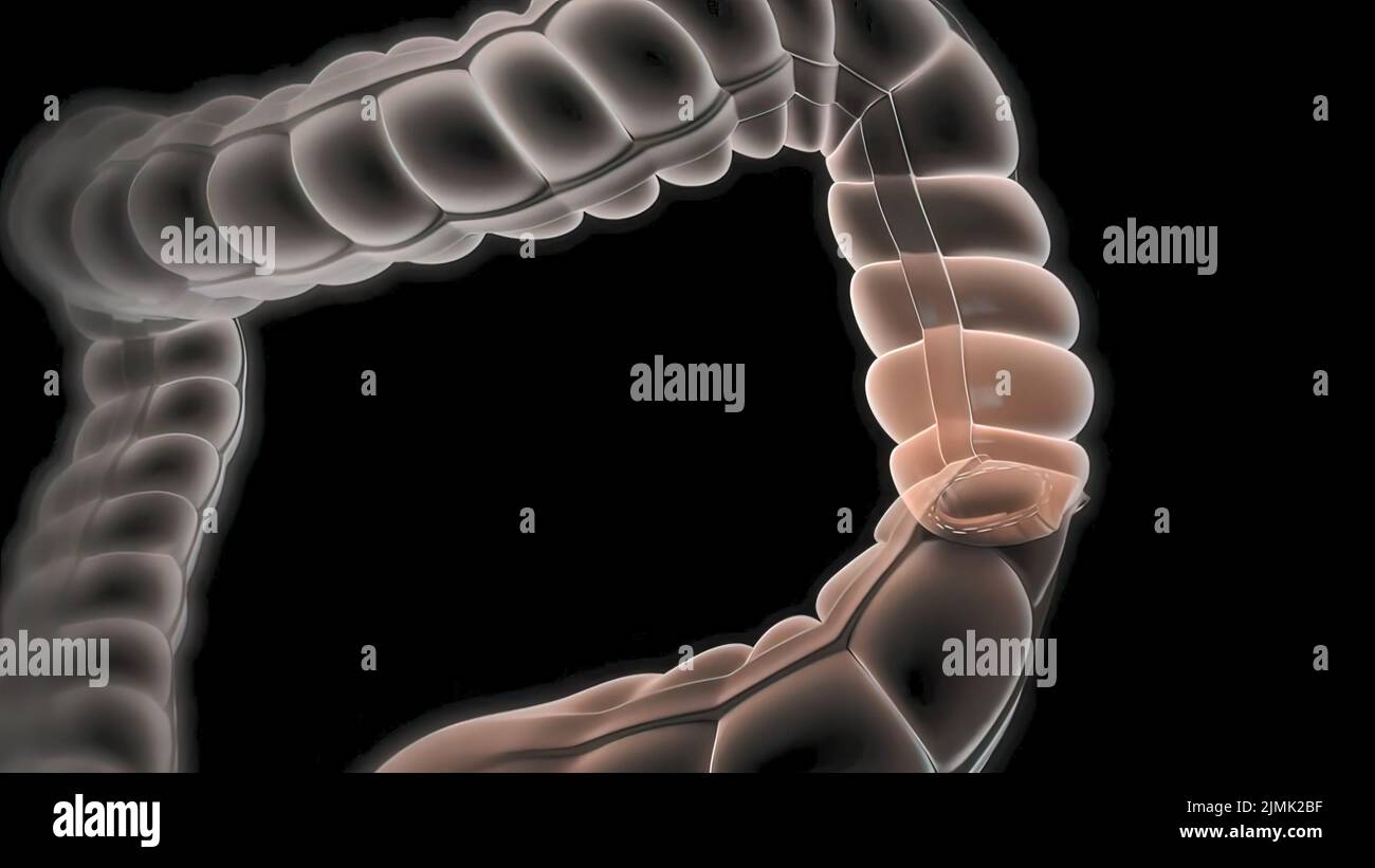 Bowel obstruction hi-res stock photography and images - Alamy