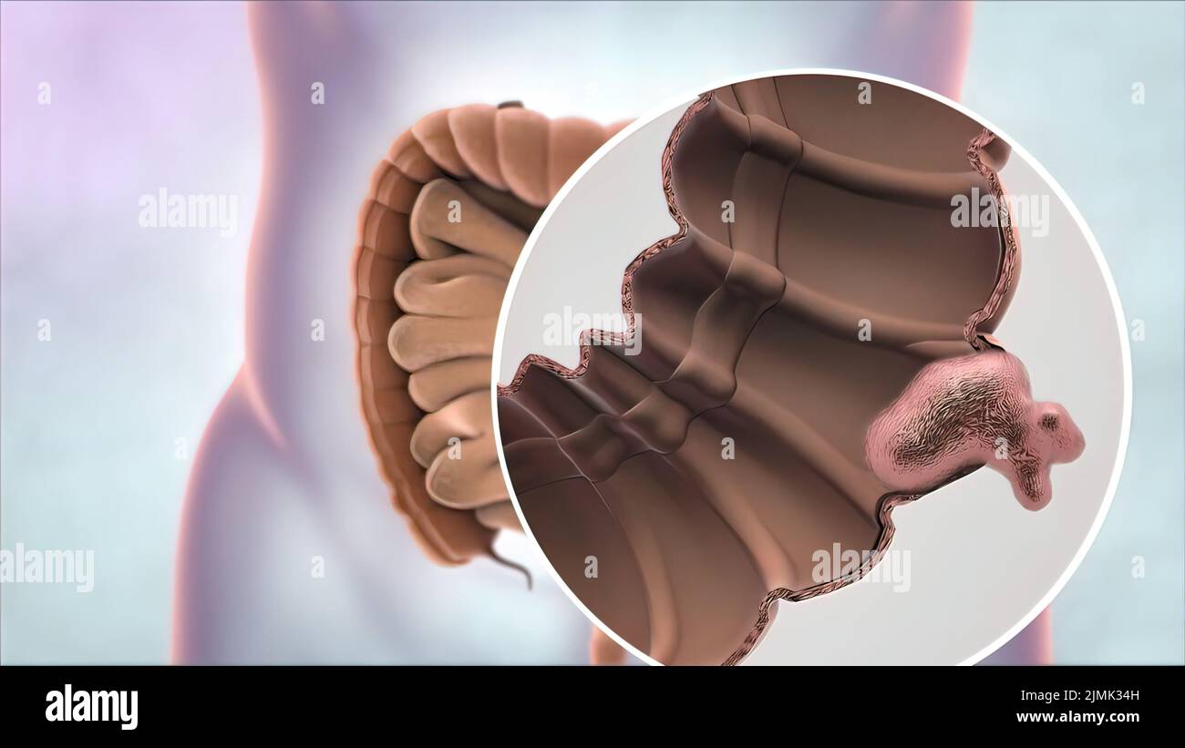 Large intestine camera hi-res stock photography and images - Alamy